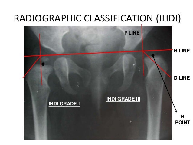 IHDI Classification of Hip Dysplasia