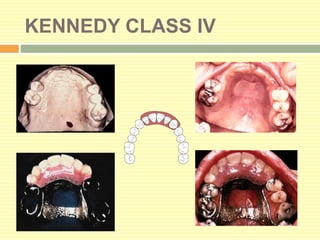 Их хэмжээний согогийн үед шүдэлбэр хийх | PPTX
