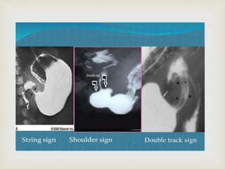 Double Track Sign Pyloric Stenosis