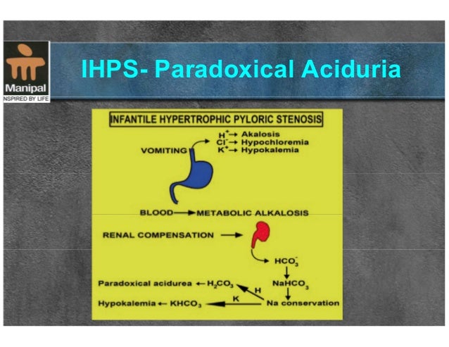 Infantile Hypertrophic Pyloric Stenosis