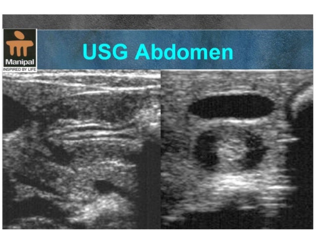 Infantile Hypertrophic Pyloric Stenosis Image Radiopaediaorg