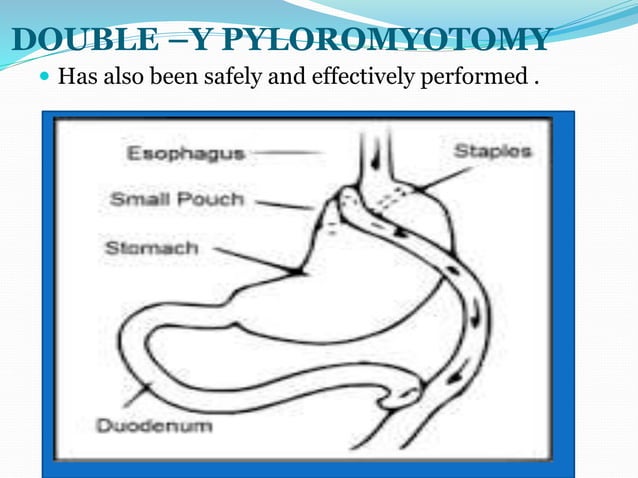 INFANTILE HYPERTROPHIC PYLORIC STENOSIS | PPT
