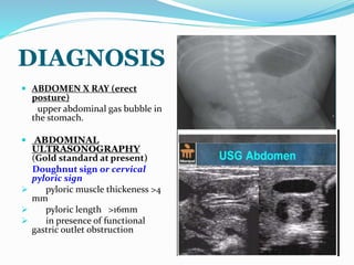 Pyloric Stenosis Xray