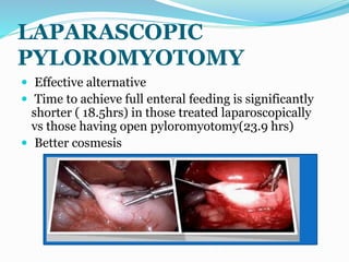 Open Pyloromyotomy