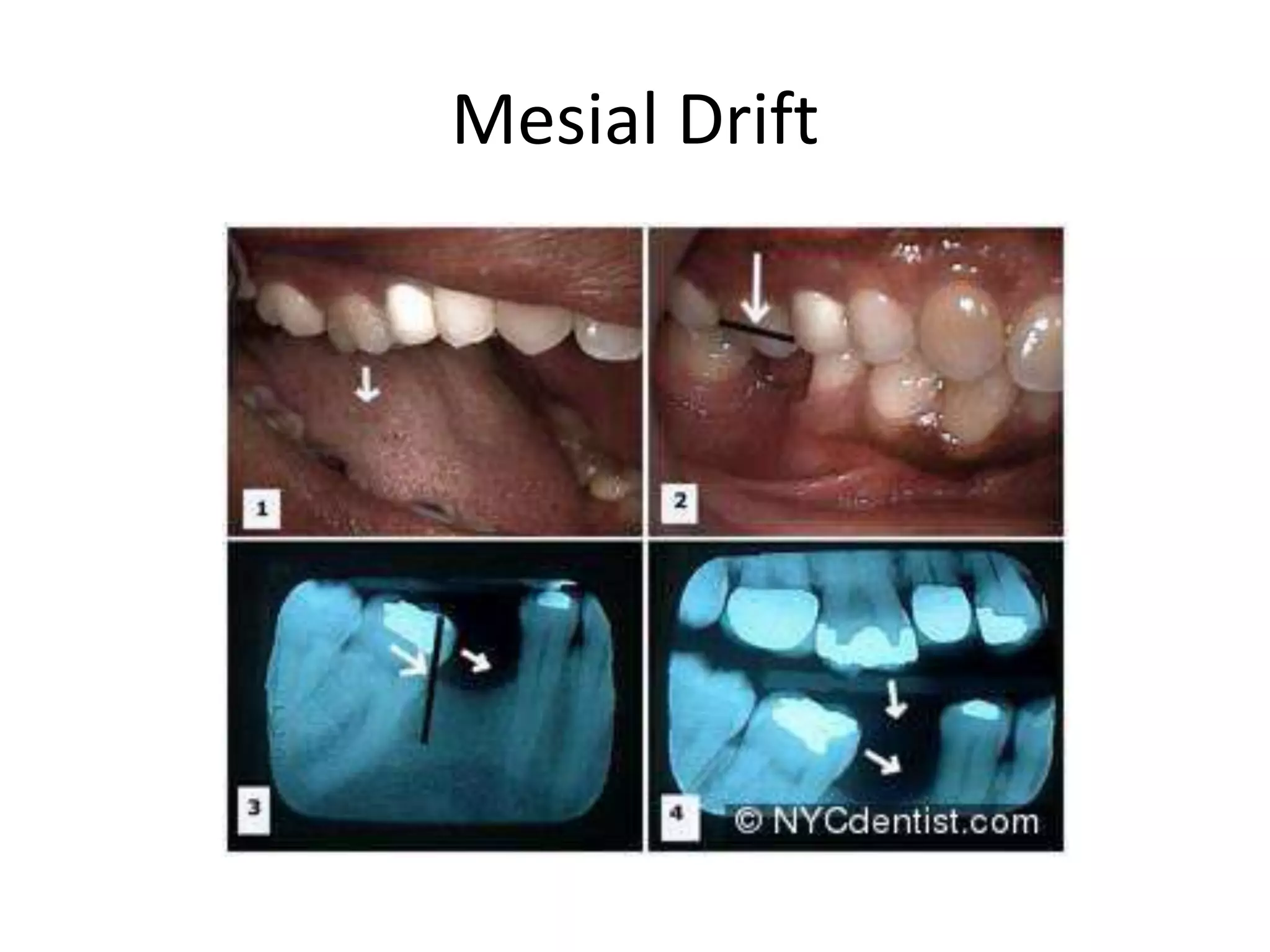 Orthodontics II | PPTX