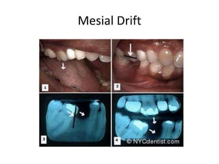 Orthodontics II | PPTX
