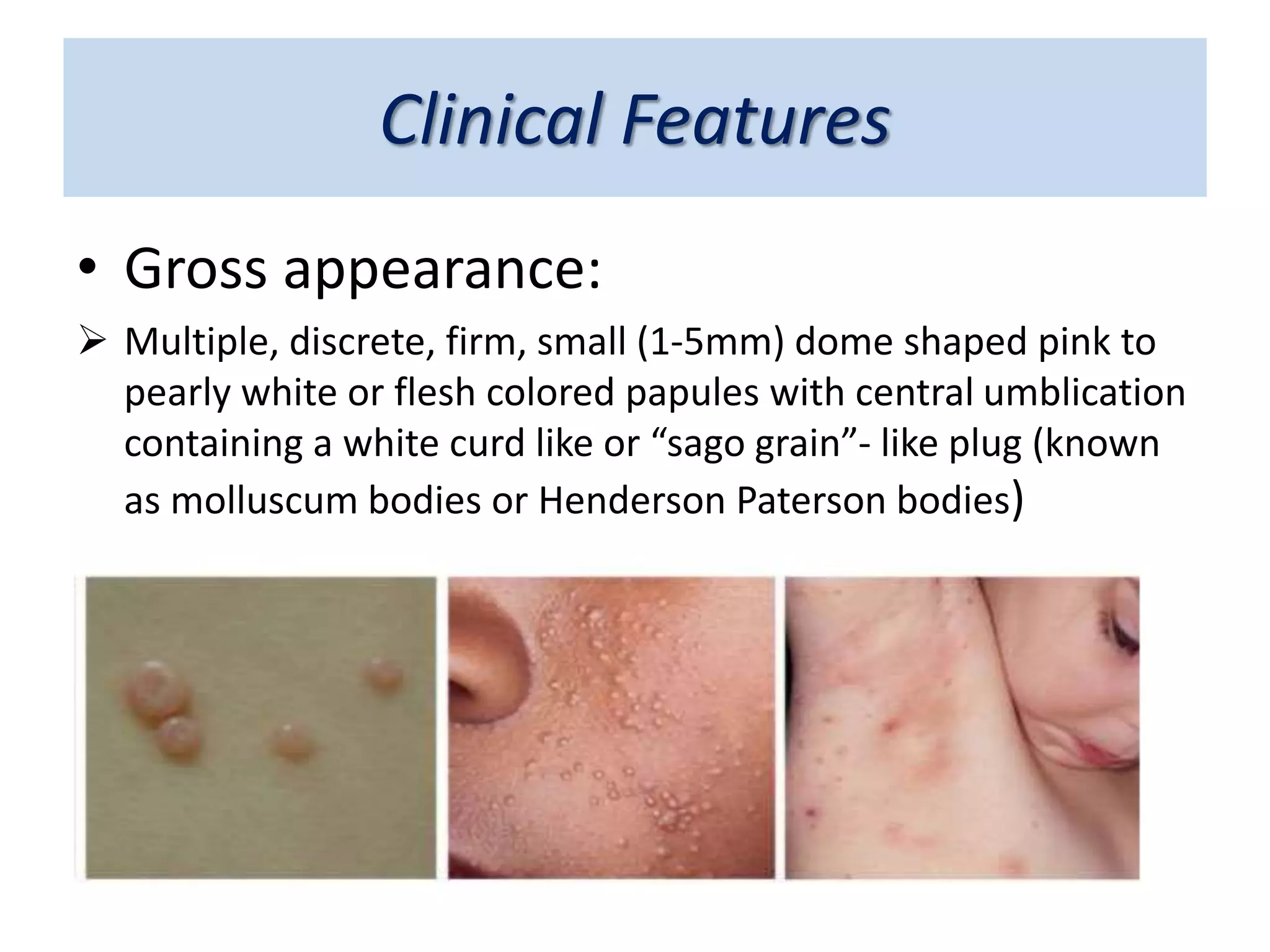 molluscum contagiosum | PPTX