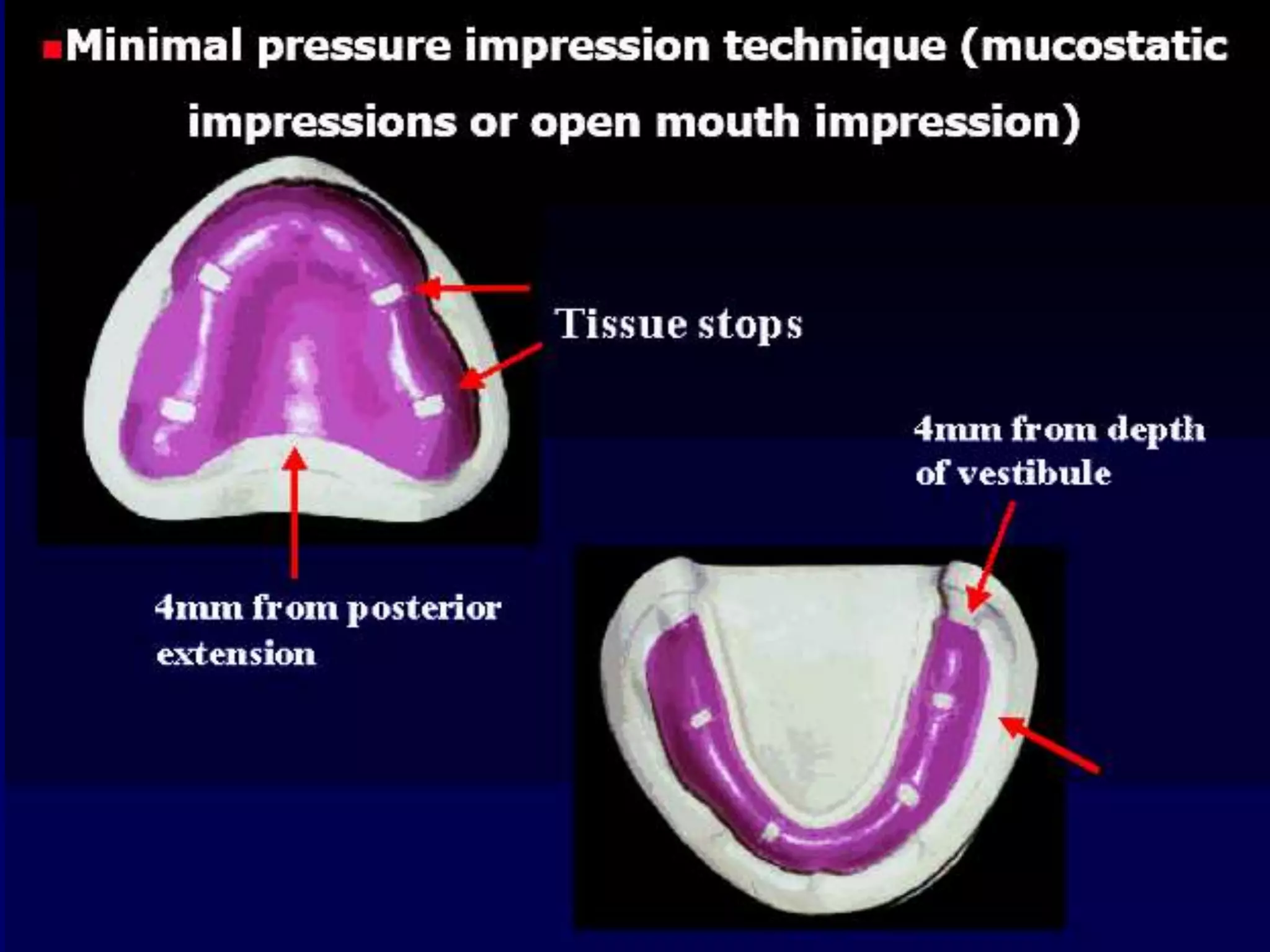 II. impression making for complete denture | PPT