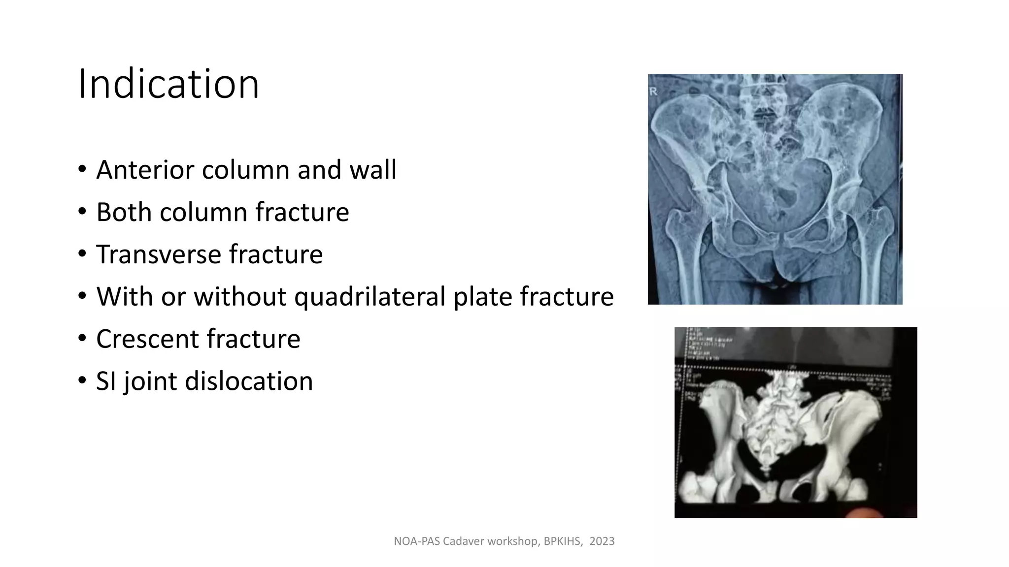 Ilioinguinal Approach PAS workshop.pptx
