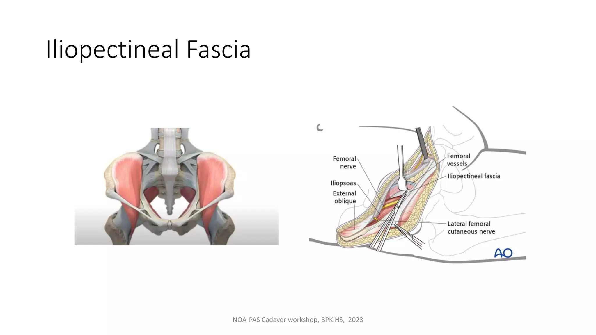 Ilioinguinal Approach PAS workshop.pptx