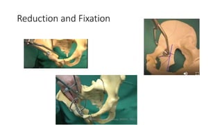 Ilioinguinal Approach PAS workshop.pptx