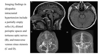 Idiopathic intracranial hypertension | PPTX