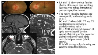 Idiopathic intracranial hypertension | PPT