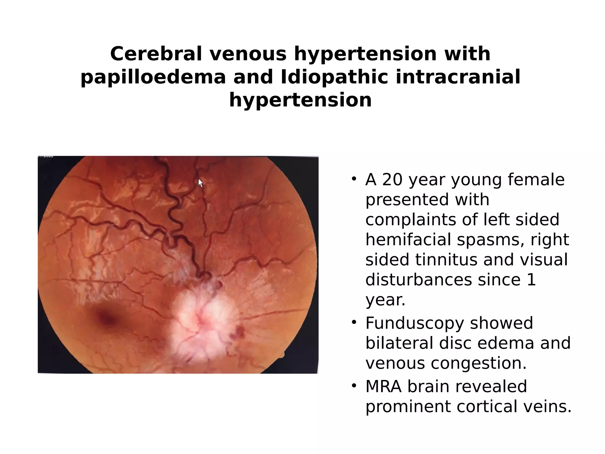 Cerebral Venous Hypertension with Papilloedema and Idiopathic ...