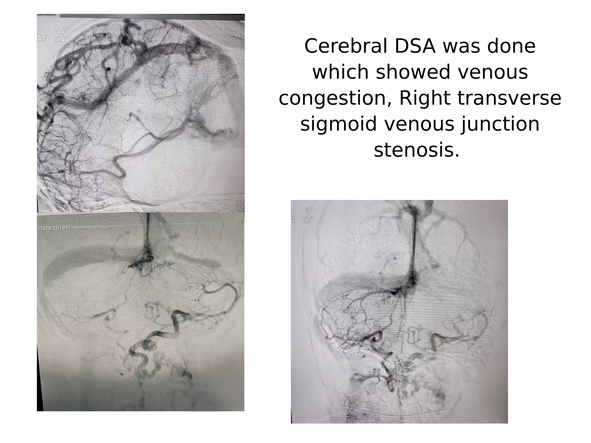 Cerebral Venous Hypertension with Papilloedema and Idiopathic ...