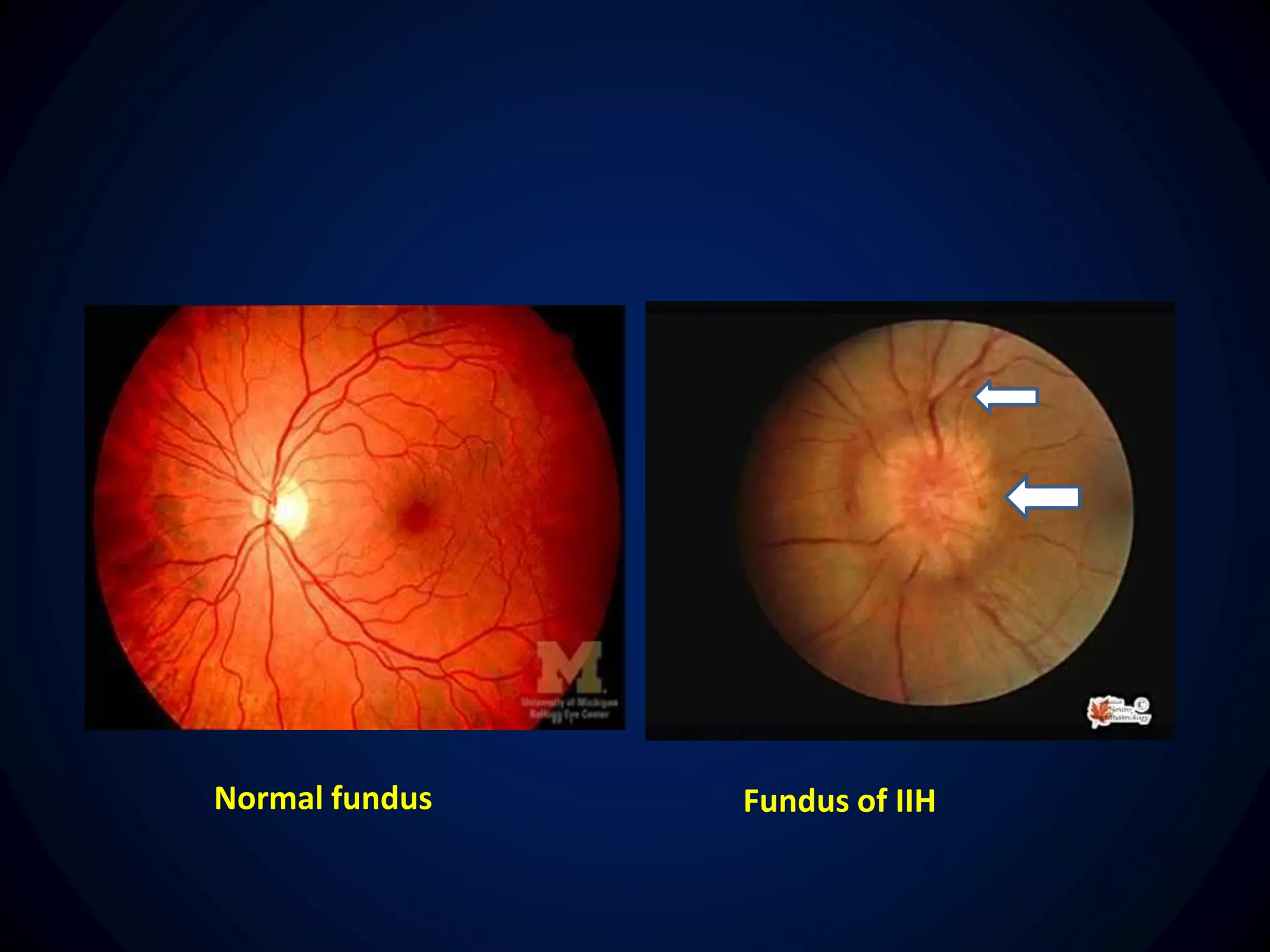 Idiopathic intracranial hypertension | PPTX