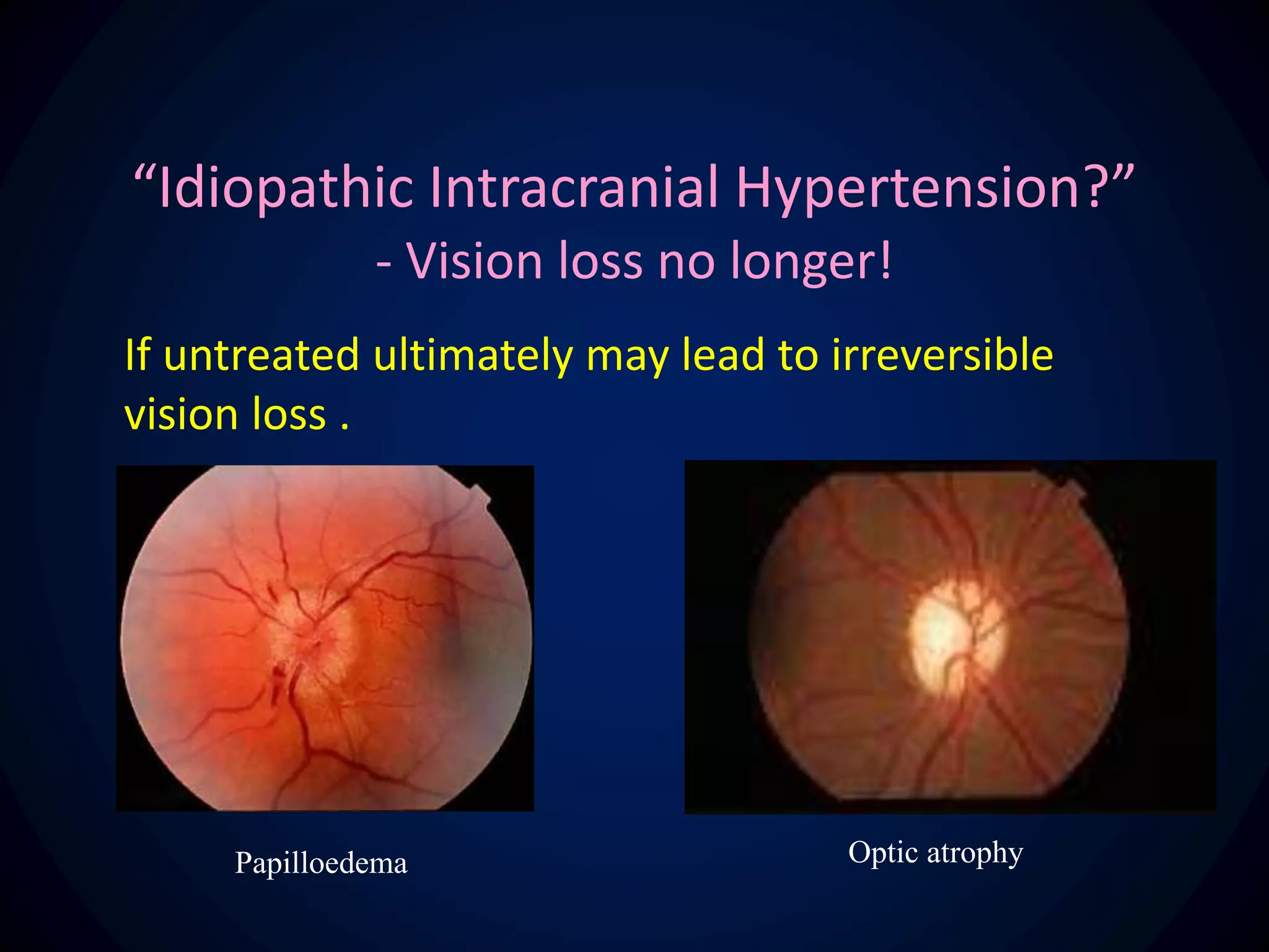 Idiopathic intracranial hypertension | PPTX