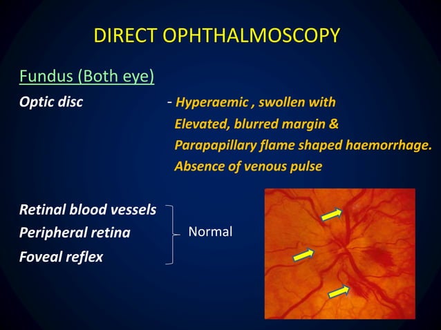 Idiopathic intracranial hypertension | PPT