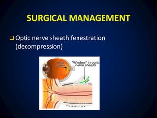 Idiopathic intracranial hypertension | PPTX