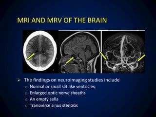 Idiopathic Intracranial Hypertension Mri