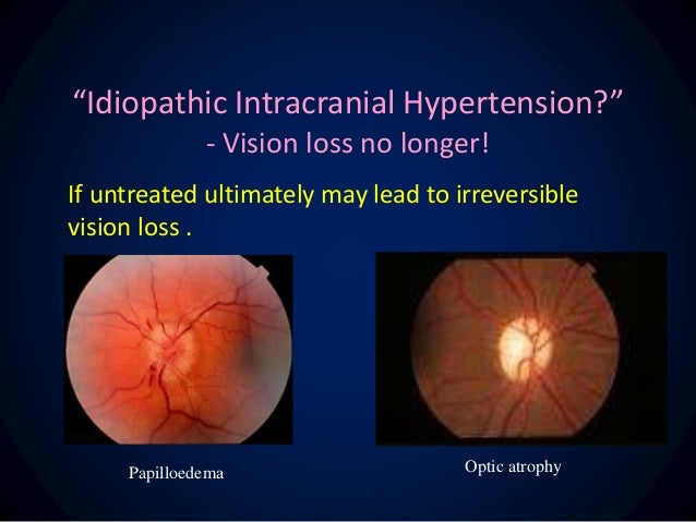 Idiopathic intracranial hypertension