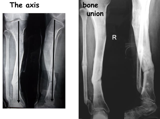 IIIb open tibia management | PPT