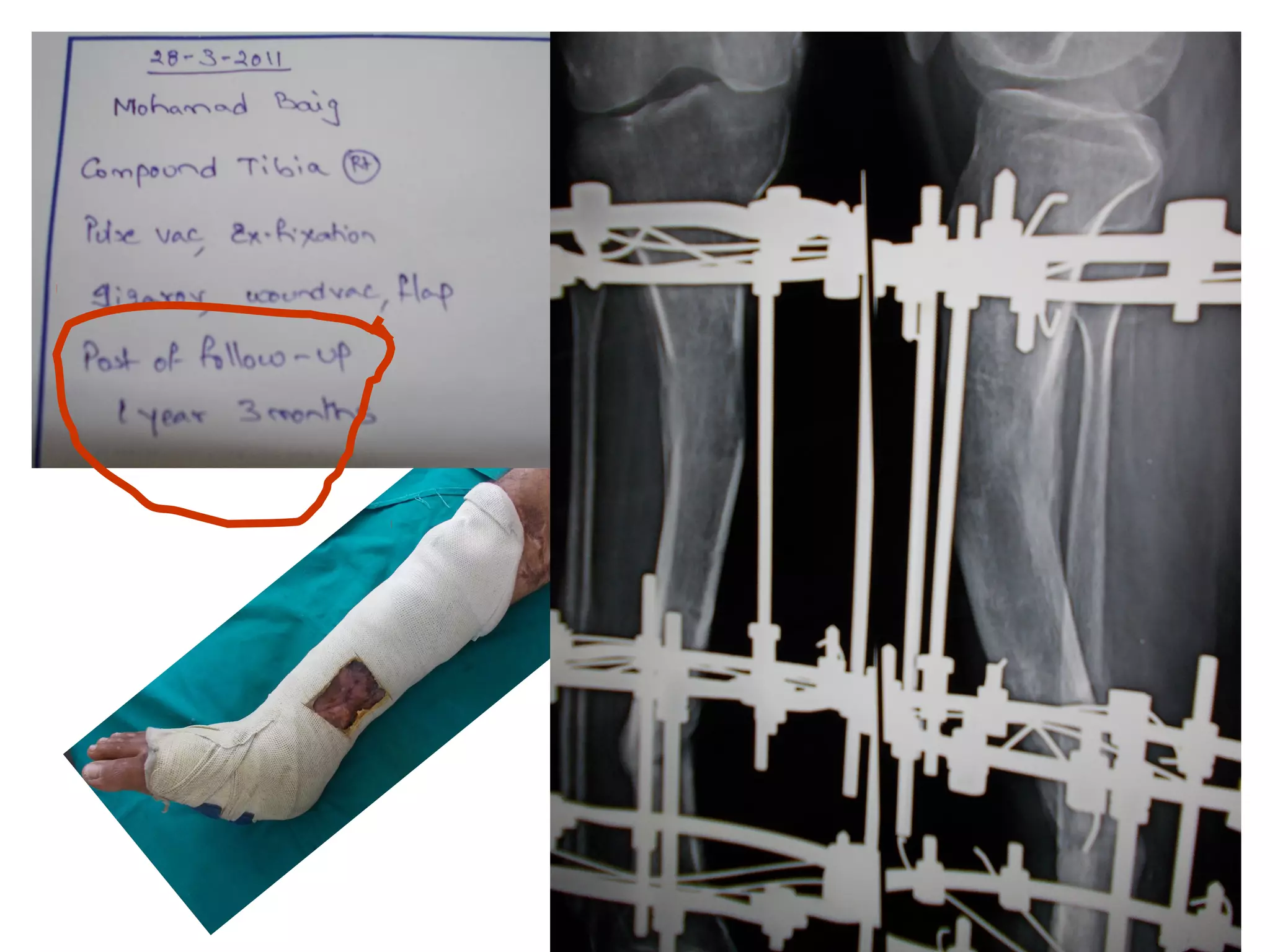 IIIb open tibia management | PPT