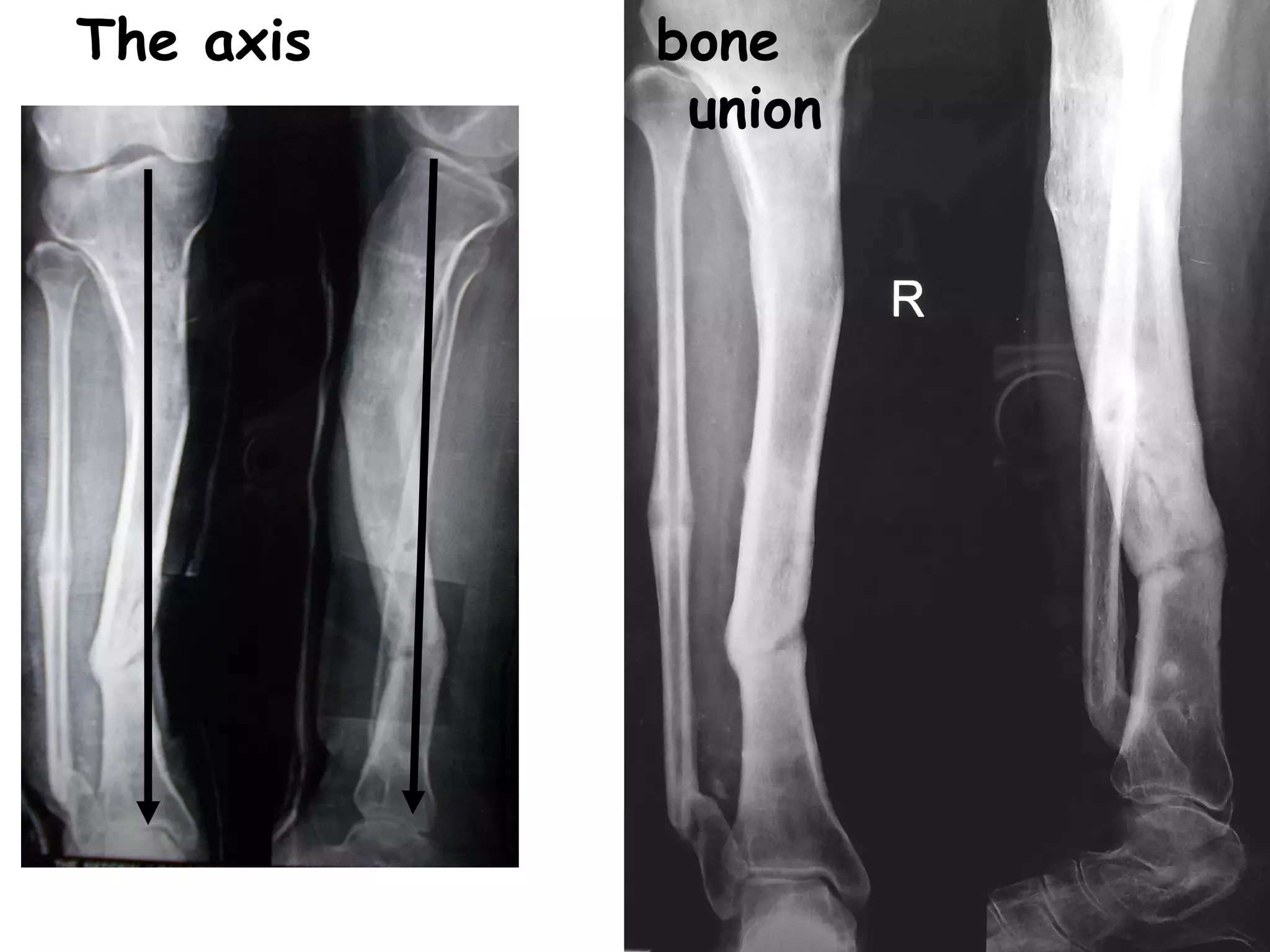 IIIb open tibia management | PPT