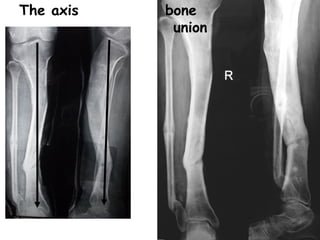 IIIb open tibia management | PPT
