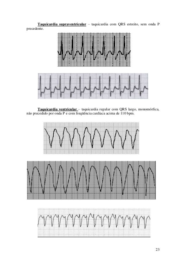III curso intensivo de eletrocardiografia básica liaga de cardiolog…