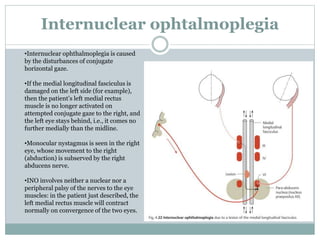 III, IV, VI Cranial nervess on the movement of eye | PPT