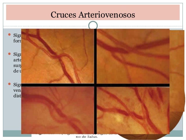 III, IV, VI Pares Craneales y oftalmoscopia