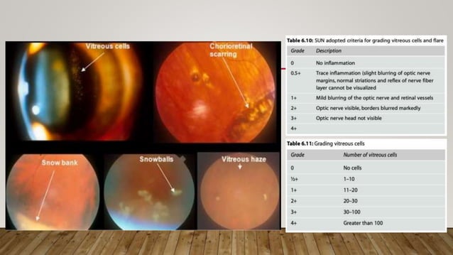 IIM- How to diagnose Uveitis.pptx