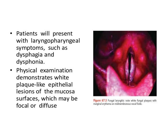 Disease of larynx