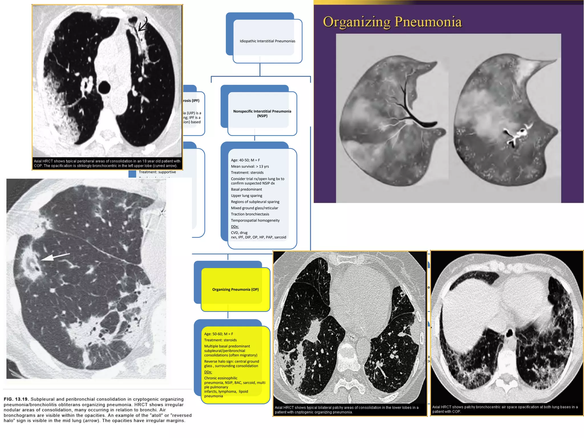 Idiopathic Interstitial Pneumonia | PPTX