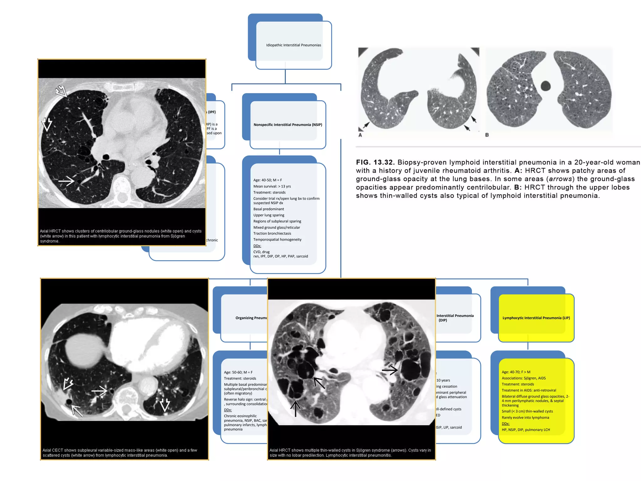 Idiopathic Interstitial Pneumonia | PPTX