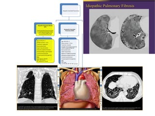 Idiopathic Interstitial Pneumonia | PPTX