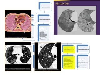 Idiopathic Interstitial Pneumonia | PPTX