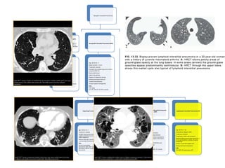 Idiopathic Interstitial Pneumonia | PPTX