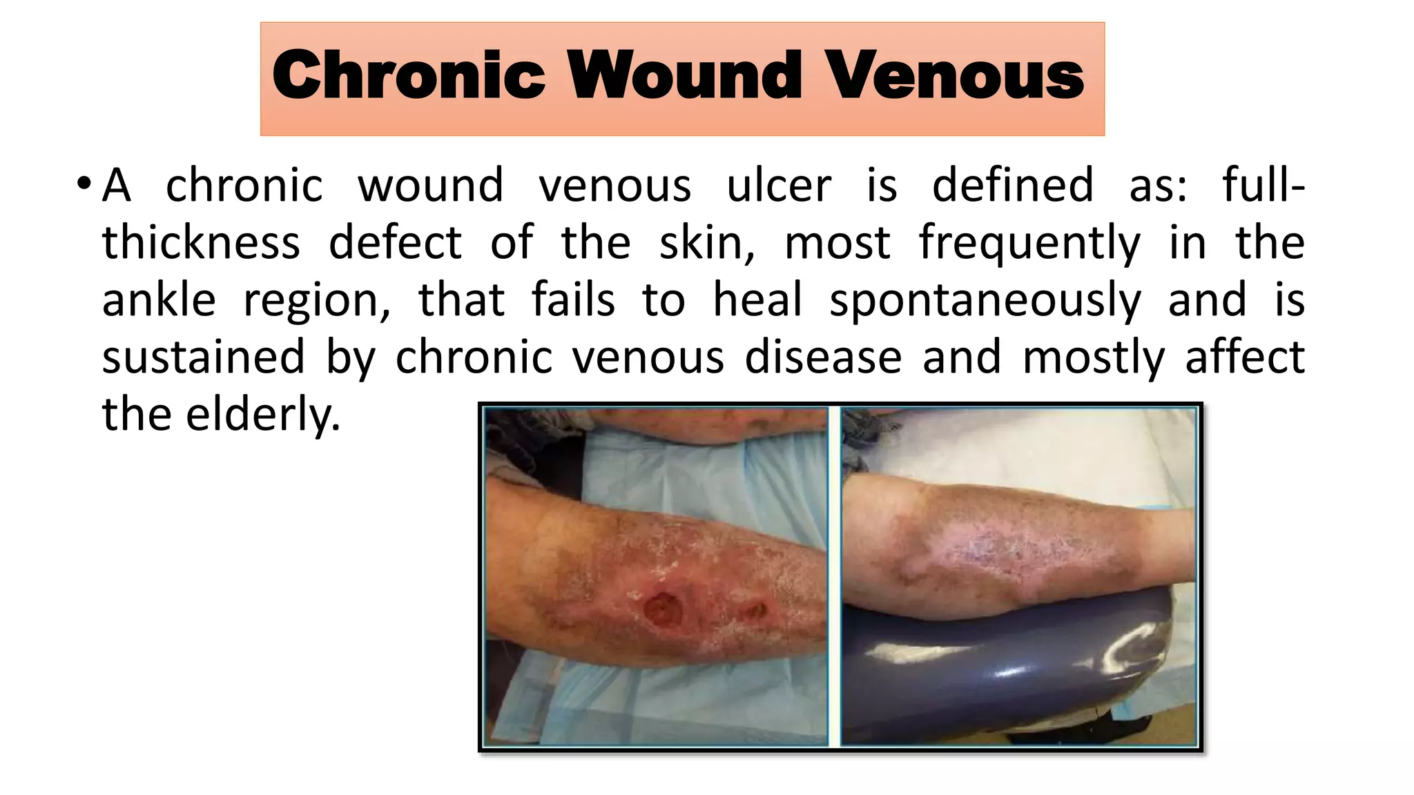 Novel Biomaterials for Chronic wound Healing for Chronic wound Healing ...
