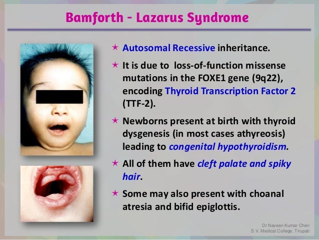 Congenital Hypothyroidism
