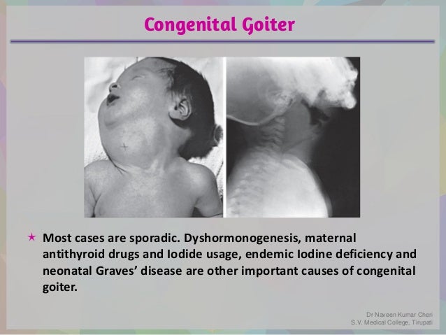 Congenital Hypothyroidism