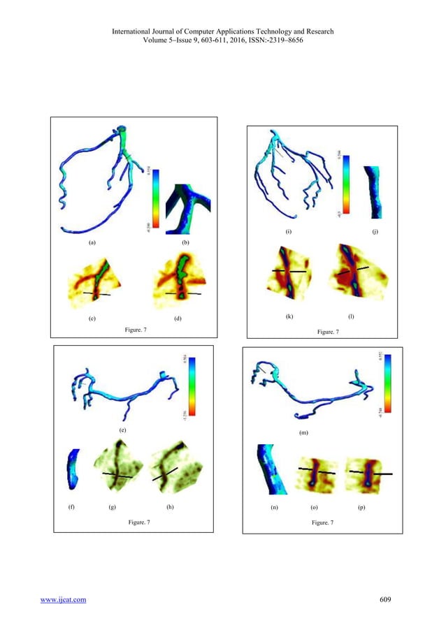 Segmentation and Visualization of Human Coronary Artery Trees from CTA Datasets | PDF