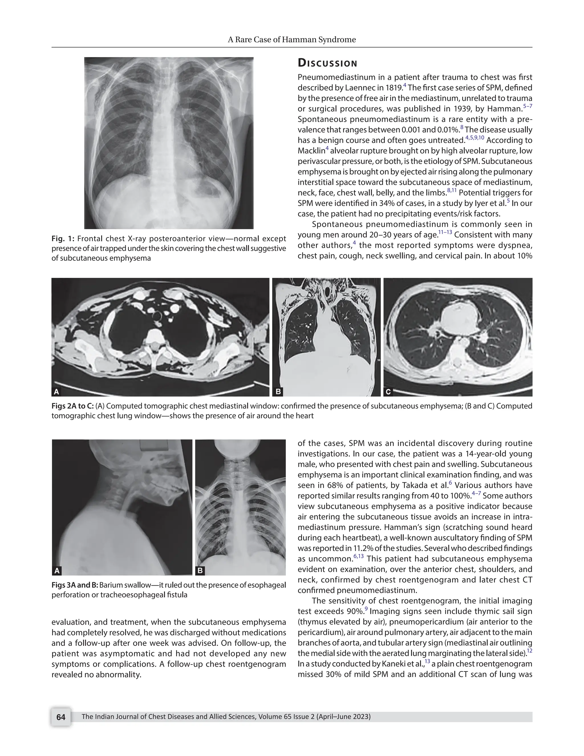 A rare case of hamman syndrome with pneumomediastinum | PDF