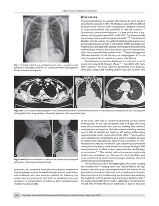 A rare case of hamman syndrome with pneumomediastinum | PDF
