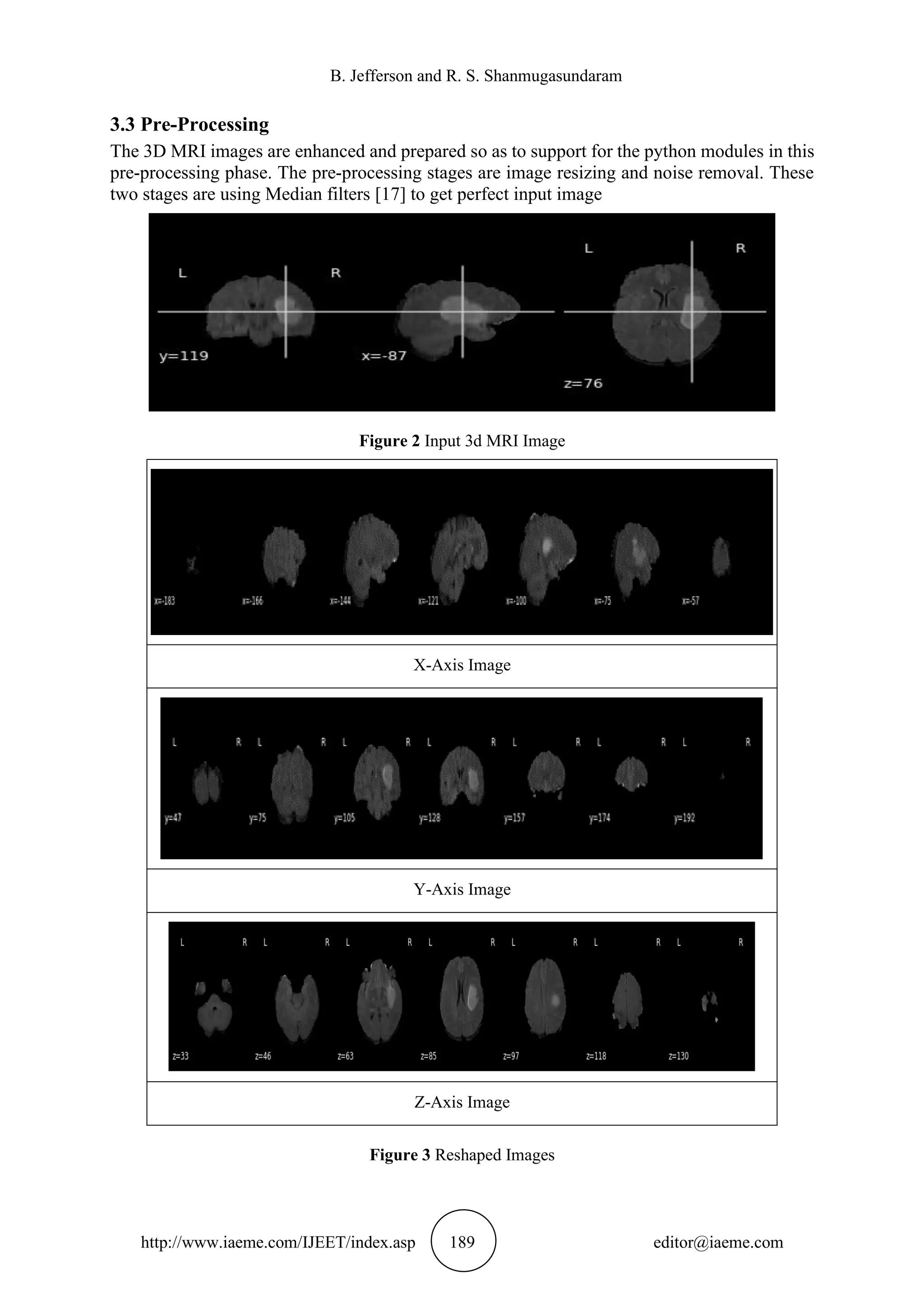 BRAIN TUMOR CLASSIFICATION IN 3D-MRI USING FEATURES FROM RADIOMICS AND 3D-CNN COMBINED WITH KNN ...