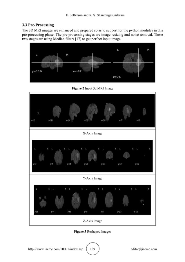 BRAIN TUMOR CLASSIFICATION IN 3D-MRI USING FEATURES FROM RADIOMICS AND 3D-CNN COMBINED WITH KNN ...