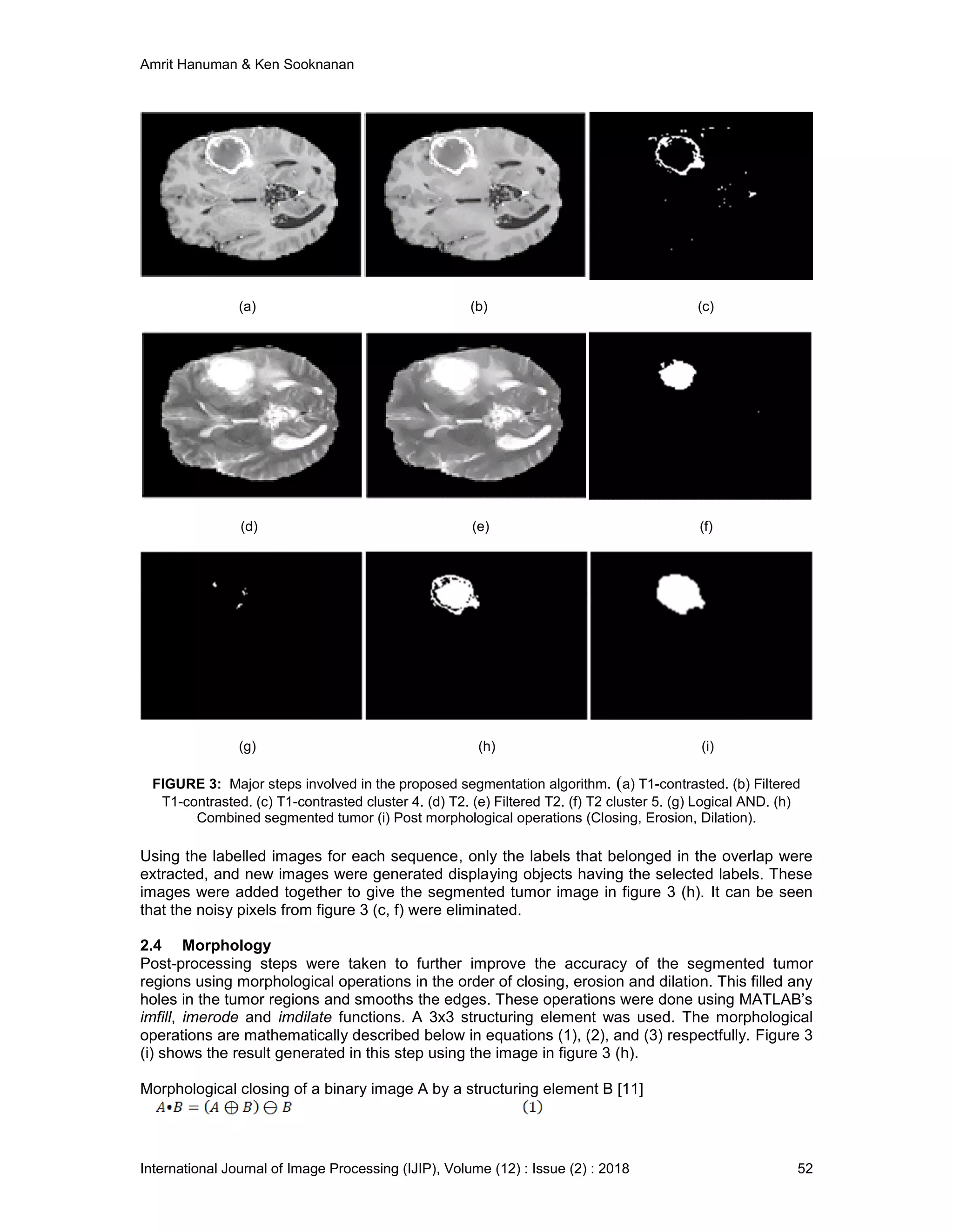 Brain Tumor Segmentation And Volume Estimation From T1 Contrasted And