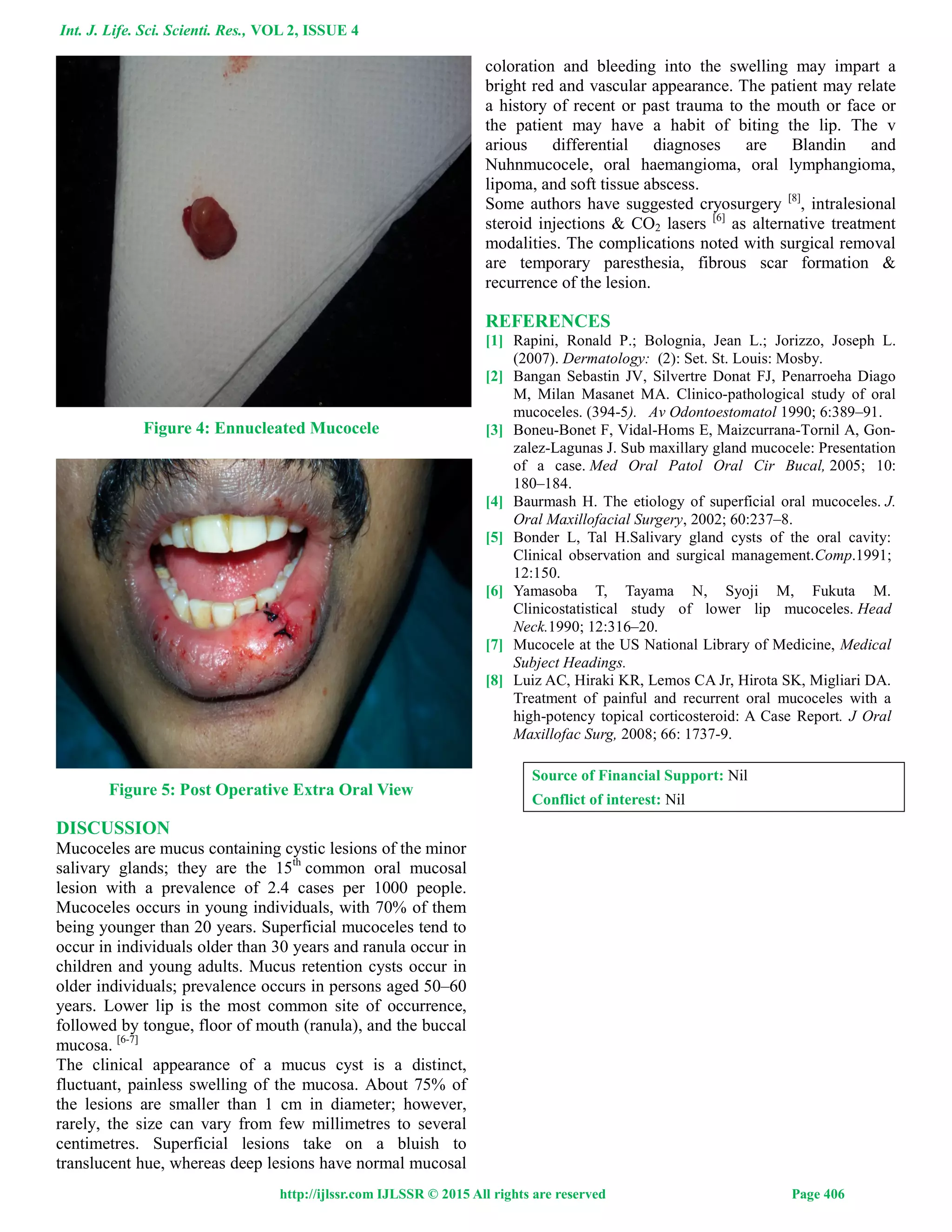 Extravasation Mucocele– A Case Report | PDF