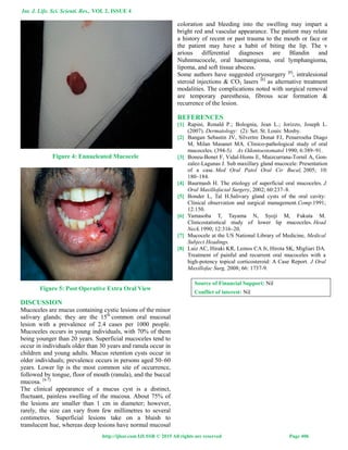 Extravasation Mucocele– A Case Report | PDF